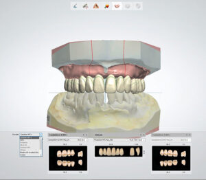 EVO Fusion Dentures - SCD