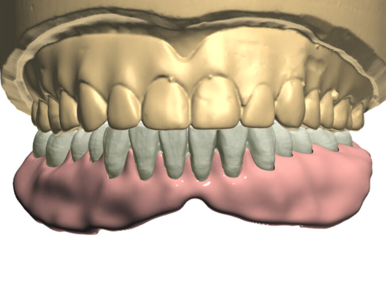 EVO Fusion Dentures - SCD
