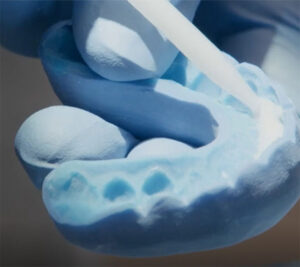 Composite Injection Technique – Tooth Wear - SCD